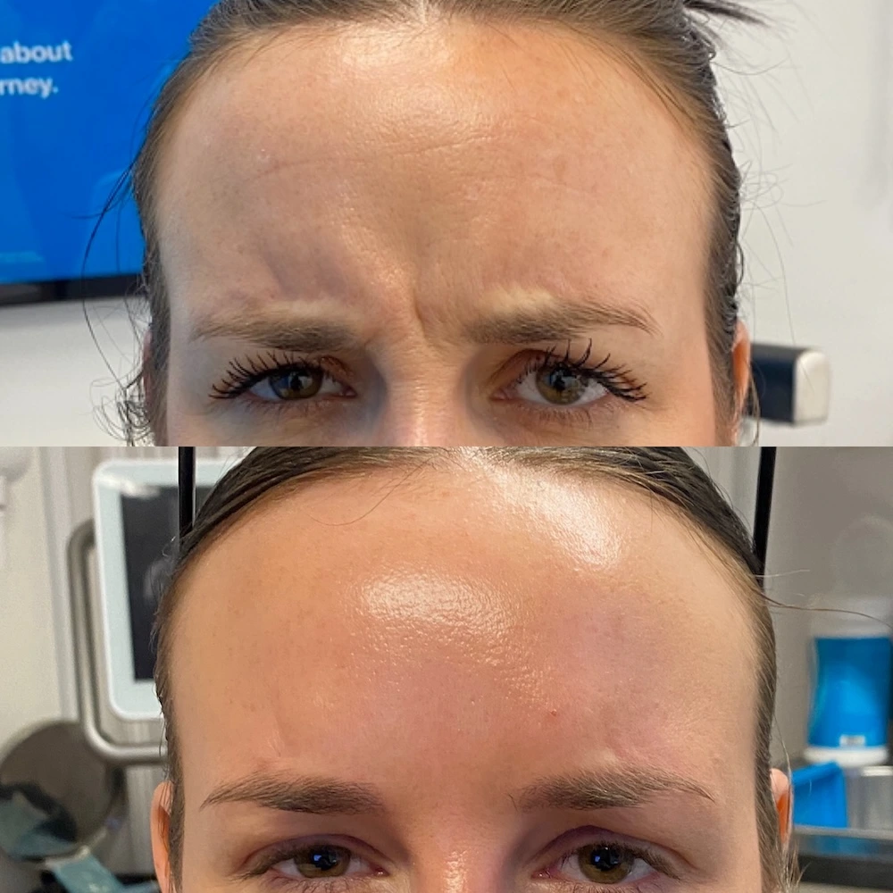 Crows feet and frown line treatments in Newcastle by Paragon